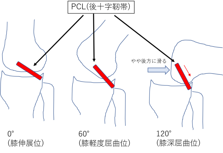 TKA術後でもロールバック機構を意識すべき！CRタイプとPSタイプでの違いについても検討。 | 理学療法士が作る「膝関節」の勉強部屋