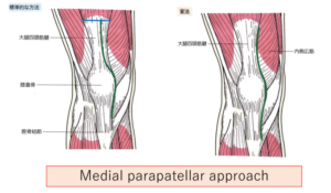 TKAの術中進入法は？Medial parapatellar approachが主流？ | 理学療法士が作る「膝関節」の勉強部屋