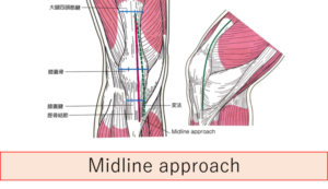 TKAの術中進入法は？Medial parapatellar approachが主流？ | 理学療法士が作る「膝関節」の勉強部屋