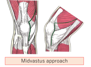 TKAの術中進入法は？Medial parapatellar approachが主流？ | 理学療法士が作る「膝関節」の勉強部屋
