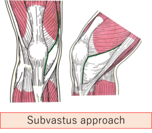 TKAの術中進入法は？Medial parapatellar approachが主流？ | 理学療法士が作る「膝関節」の勉強部屋