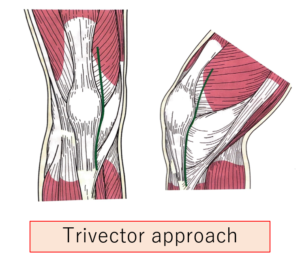 TKAの術中進入法は？Medial parapatellar approachが主流？ | 理学療法士が作る「膝関節」の勉強部屋