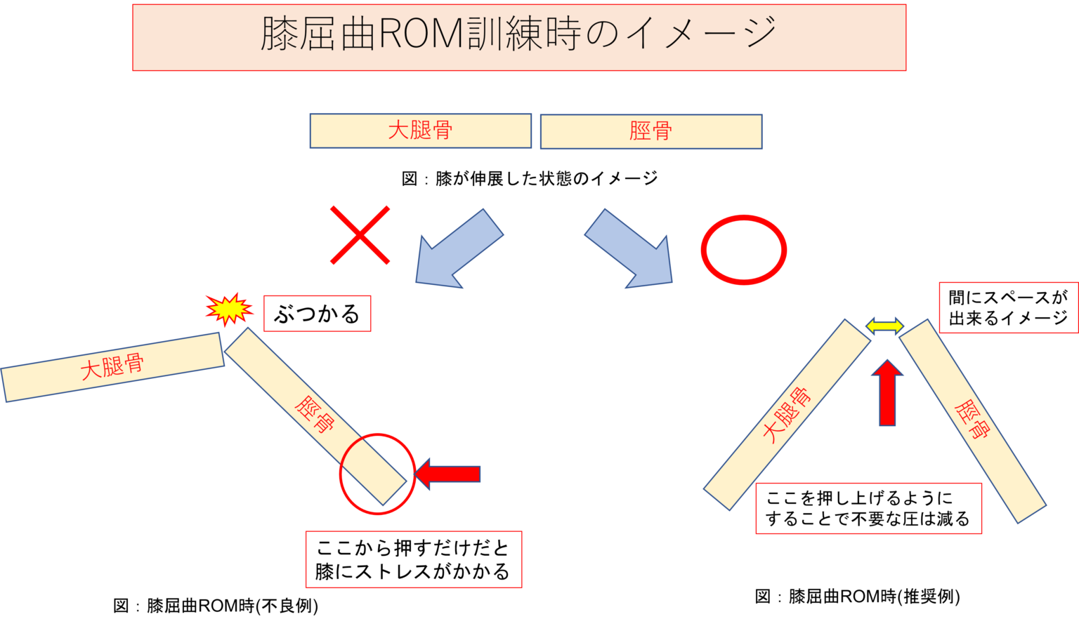 TKA術後の膝屈曲ROMの改善に対するアプローチについて～ROM訓練編～ | 理学療法士が作る「膝関節」の勉強部屋