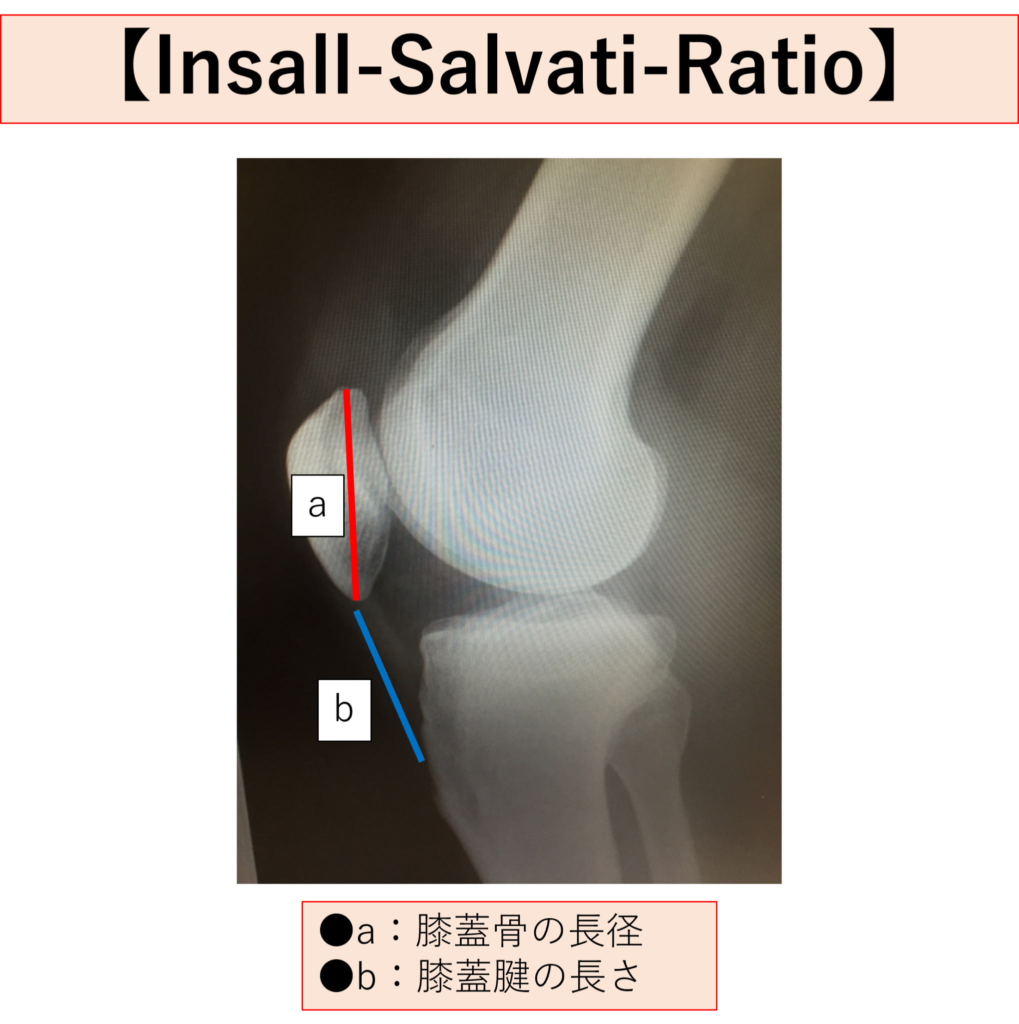 膝蓋骨アラインメントを評価する方法；膝蓋骨の位置の評価(Insall–Salvati ratio)について | 理学療法士が作る「膝関節」の勉強部屋