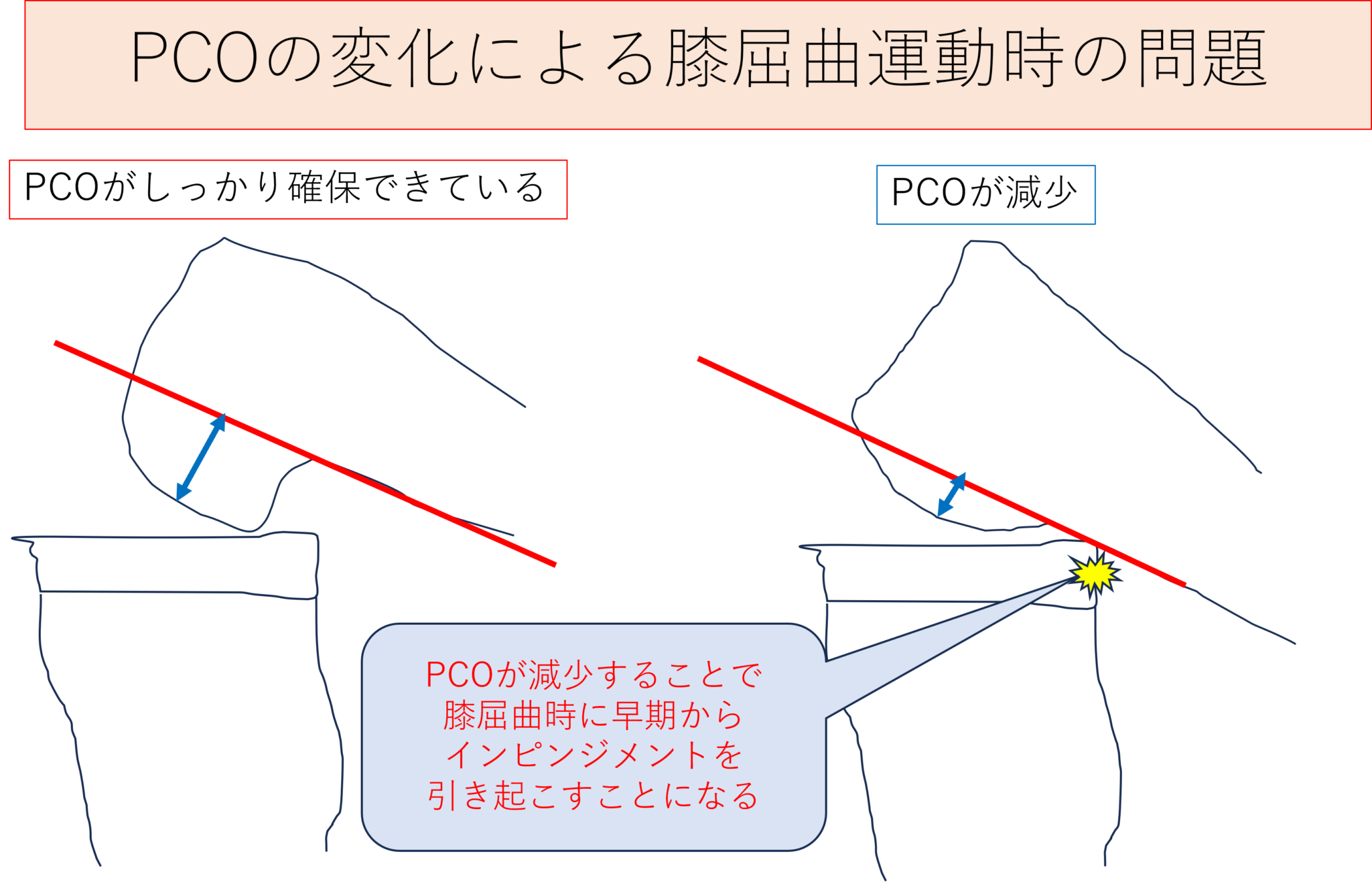 人工膝関節術後の膝屈曲ROMと関連のある”大腿骨後顆の突出度合い(PCO)”について | 理学療法士が作る「膝関節」の勉強部屋
