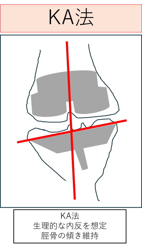 人工膝関節のアライメントについて～KA法とMA法～ | 理学療法士が作る「膝関節」の勉強部屋